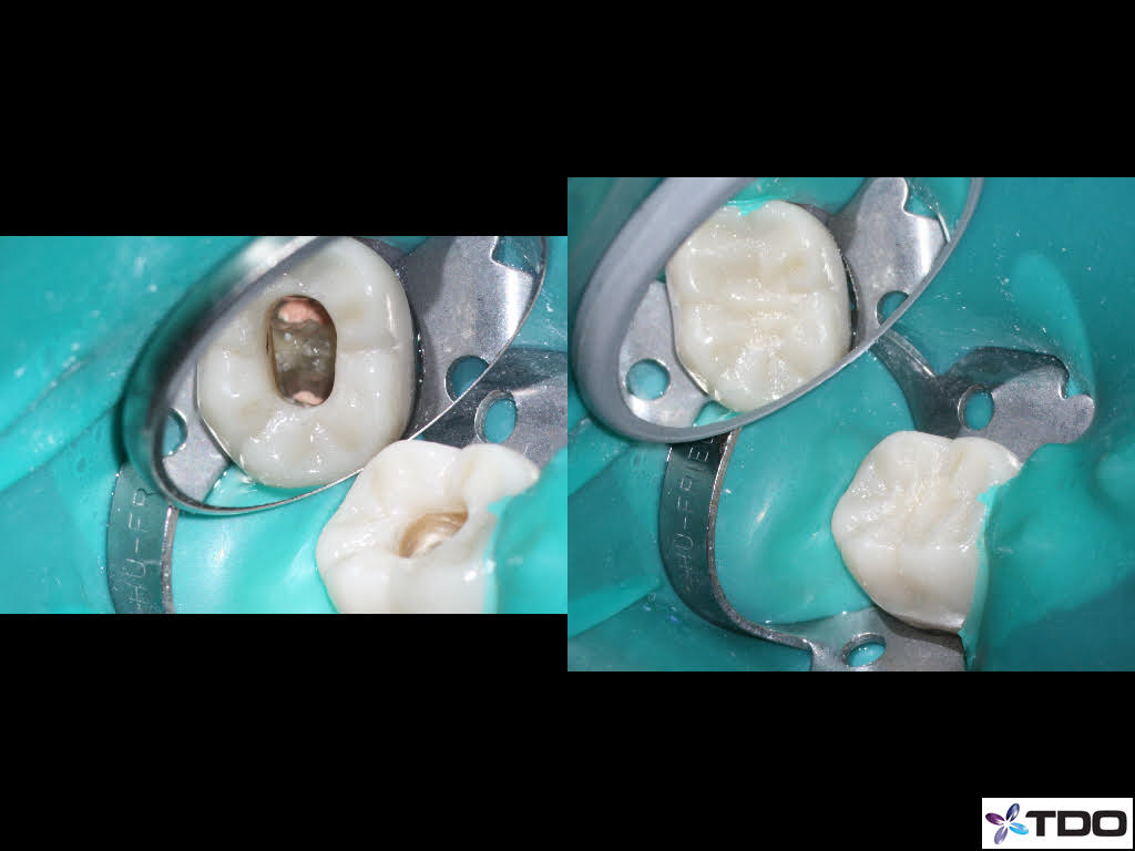 Crown Repair – Welcome to LU Endodontics